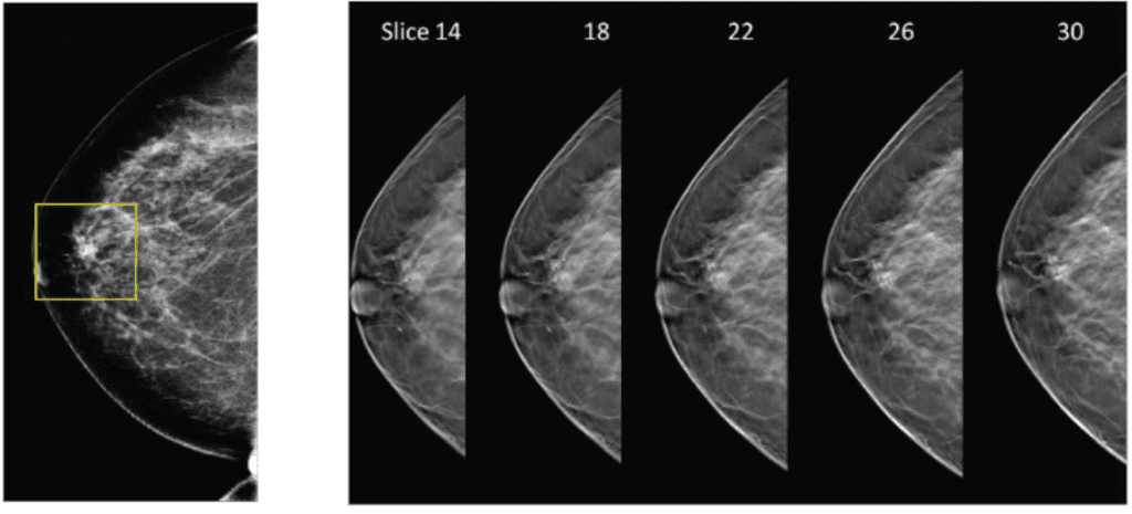 Mammography - Piedmont HealthCare