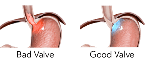 TIF Procedure for GERD Rellief - Piedmont HealthCare
